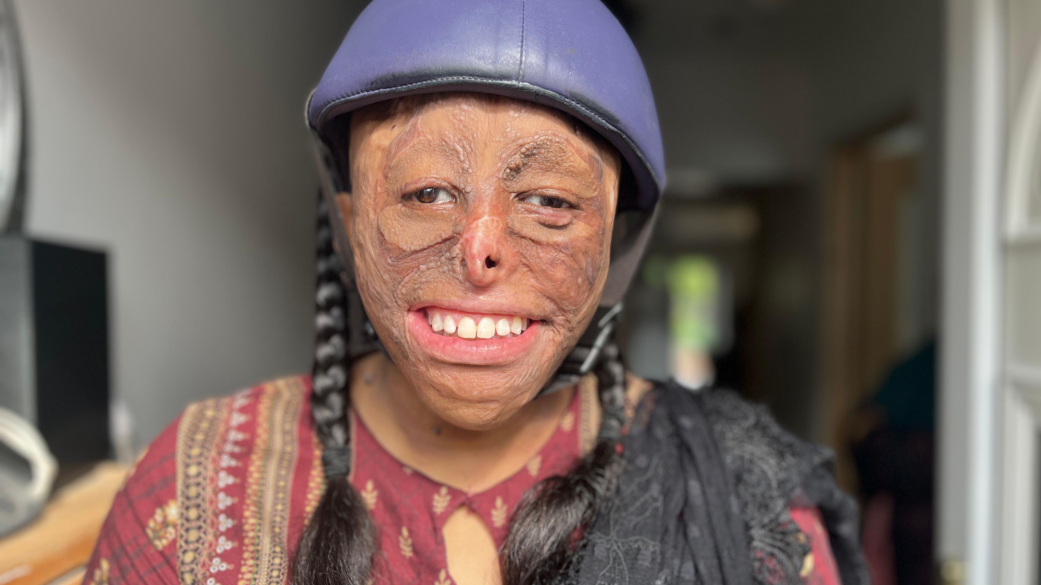 Severe Burn Victims Face