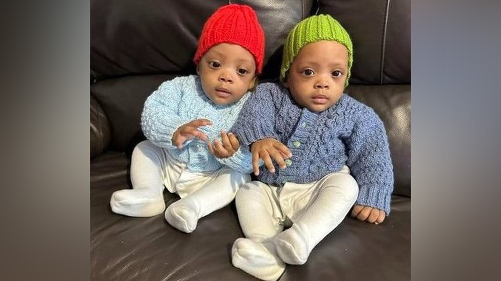 Conjoined Twins Before And After Former Conjoined Twins Practice