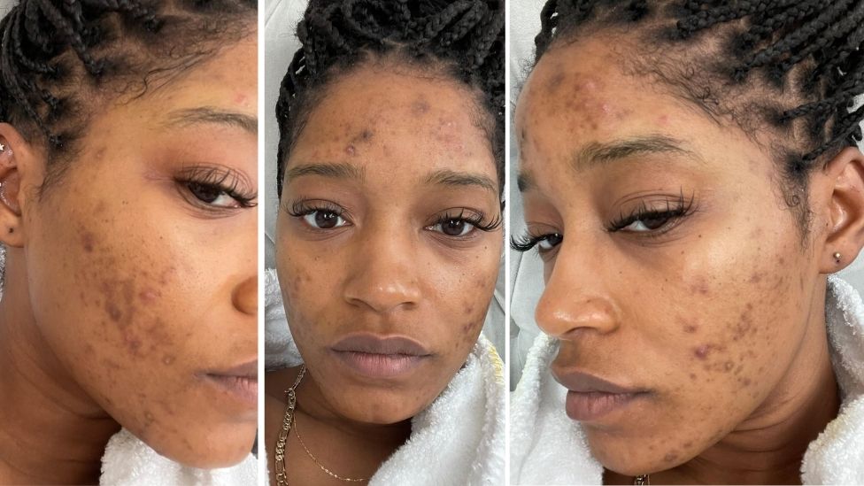 Celebrities Suffering From Pcos 60 Photos - Moonagedaydream.film