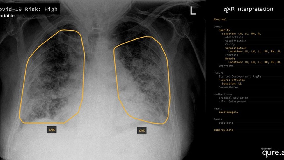 Cxr Corona Cxr Corona