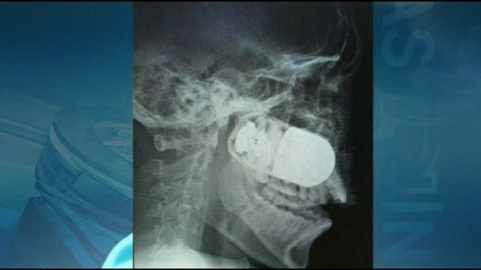 Soldier with a grenade stuck in his face operated on - BBC News