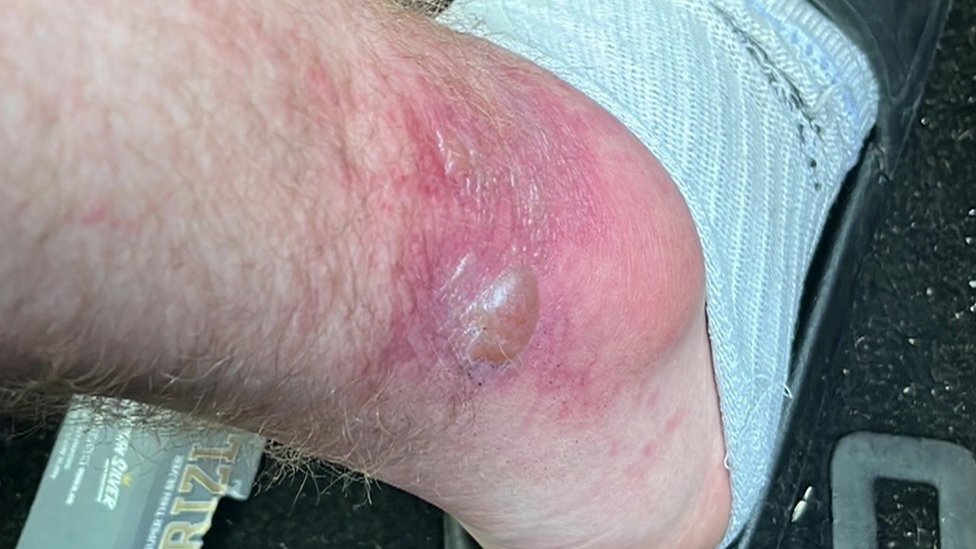 Hogweed Reaction