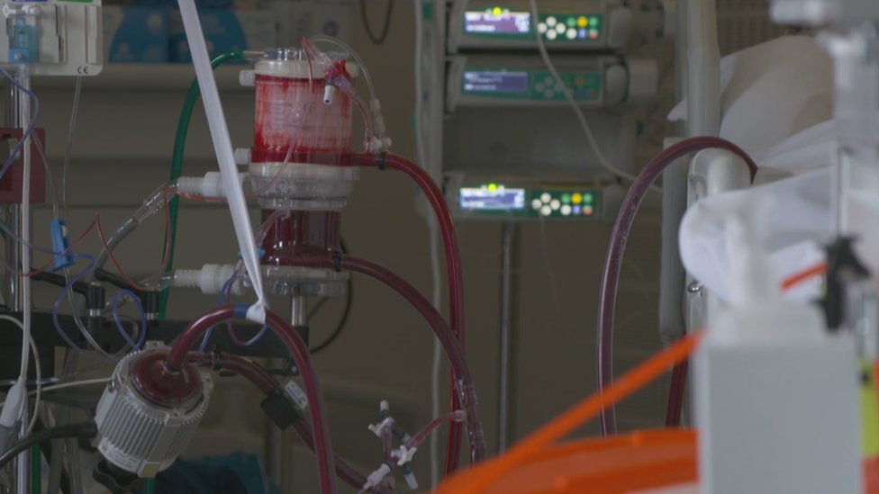 ECMO - The Covid patient who got the most intensive care - BBC News
