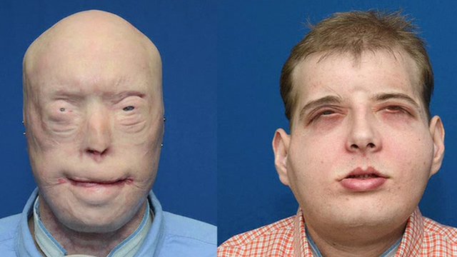 The man with a new face after 'world's most extensive' transplant - BBC ...